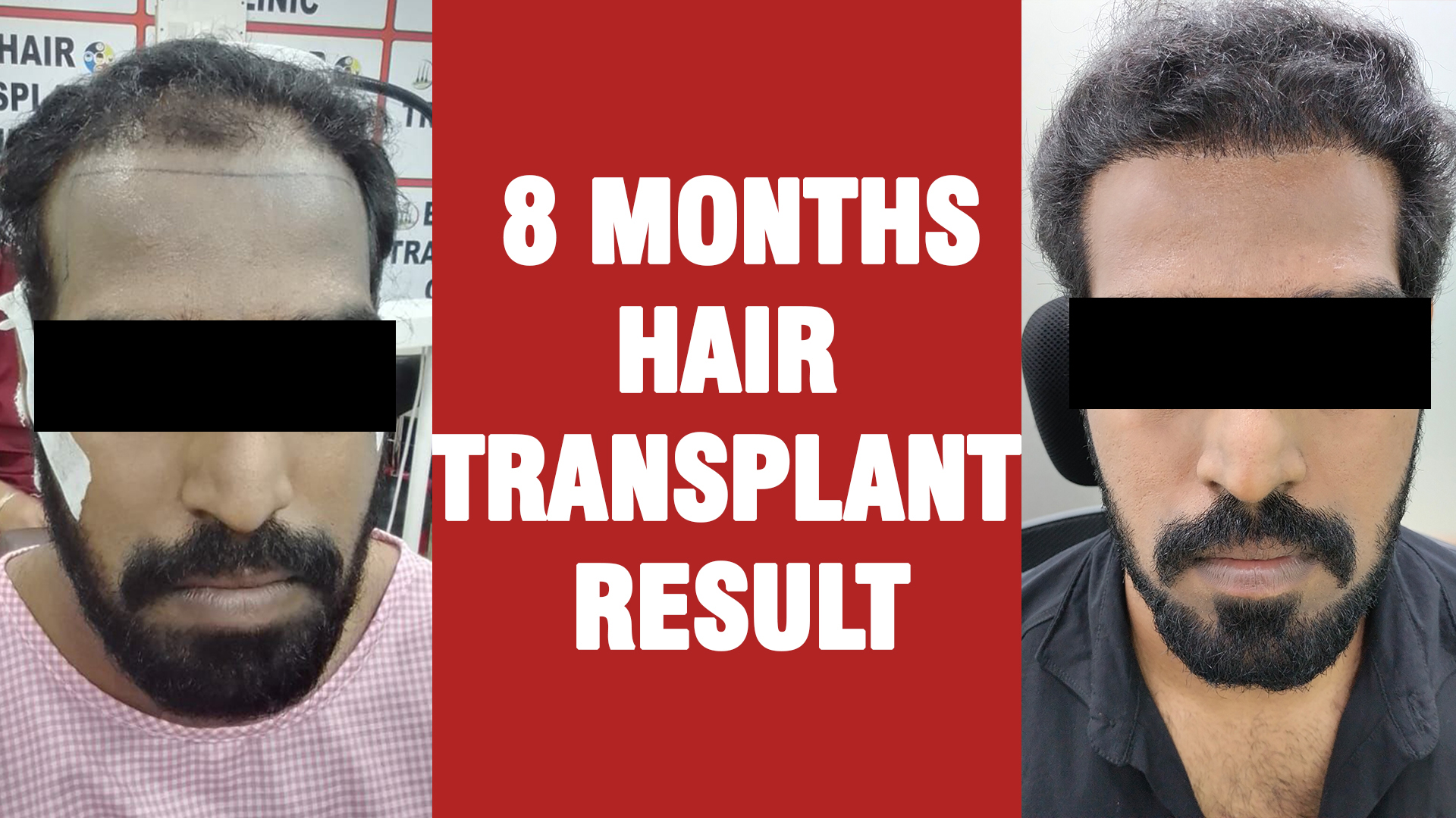 Ultra Bio Hair Transplant Clinic