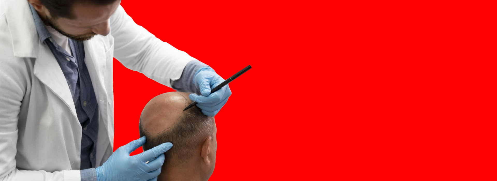 Ultra Bio Hair Transplant Clinic Chennai