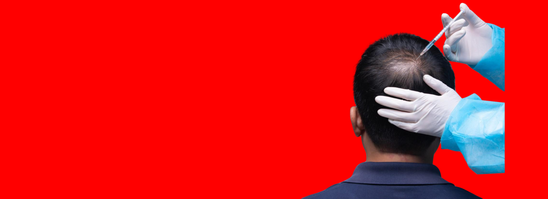 Ultra Bio Hair Transplant Clinic Chennai